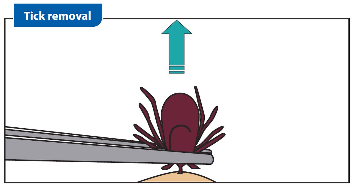 How can you remove a tick - and what's the best way to avoid ticks in ...